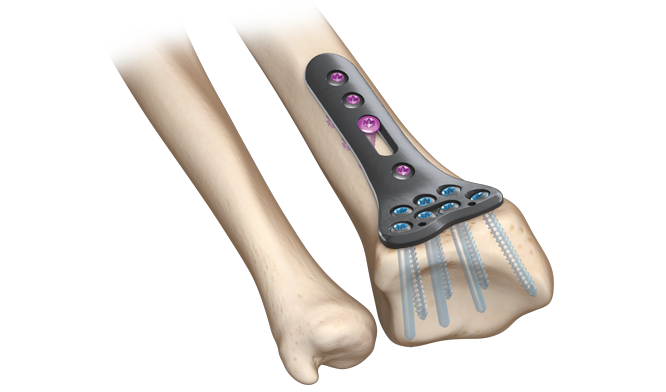 Variax 2 Distal Radius Stryker